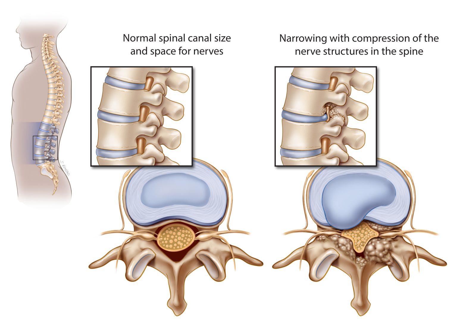 Lumbar Conditions and Procedures - Oregon Spine Care